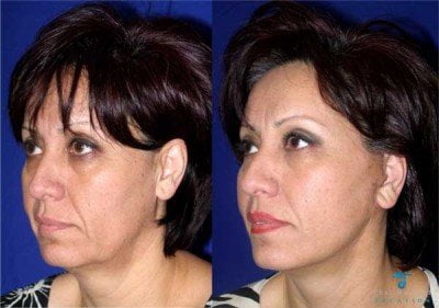 Best Mini & Micro Facelifts in Thailand – Rejuvenate & Restore