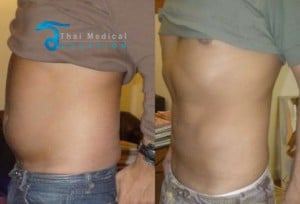Certified BodyTite RFAL Liposuction Technology – Fast Recovery