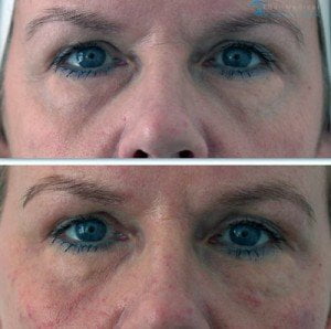 The Vampire Facelift in Thailand | HA Filler and PRP