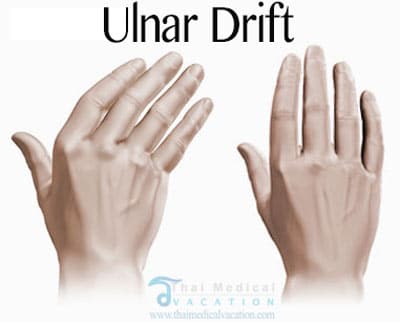 Hand and Wrist Surgery to Repair Injuries