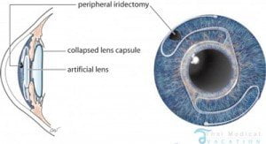 Cataract Surgery Using Phacoemulsification PHACO