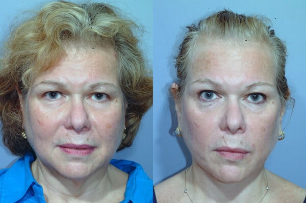 Best Mini & Micro Facelifts in Thailand - Rejuvenate & Restore